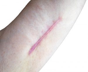Linear hypertrophic scar - www.Strataderm.com