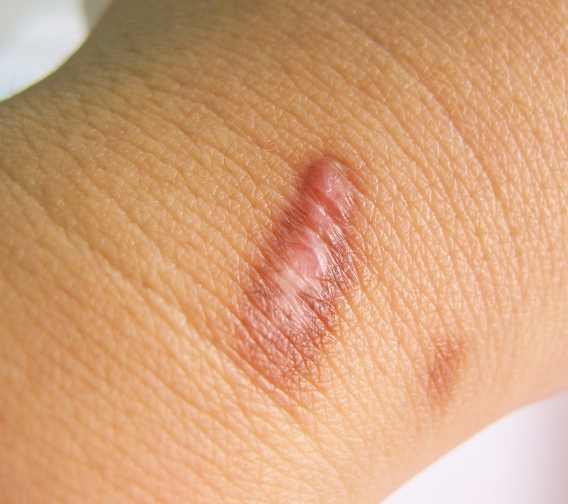 Scar on human skin - www.Strataderm.com