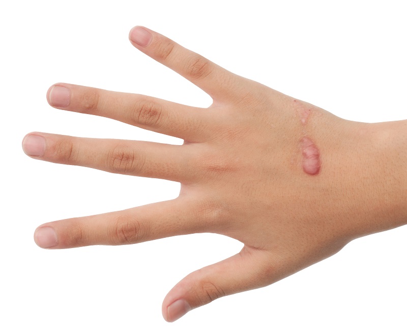 minor - www.Strataderm.com