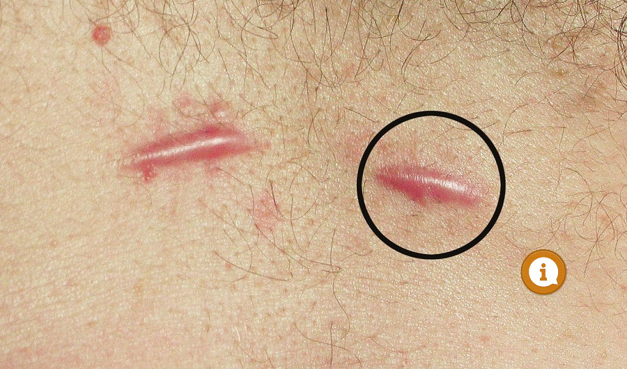 before - www.Strataderm.com